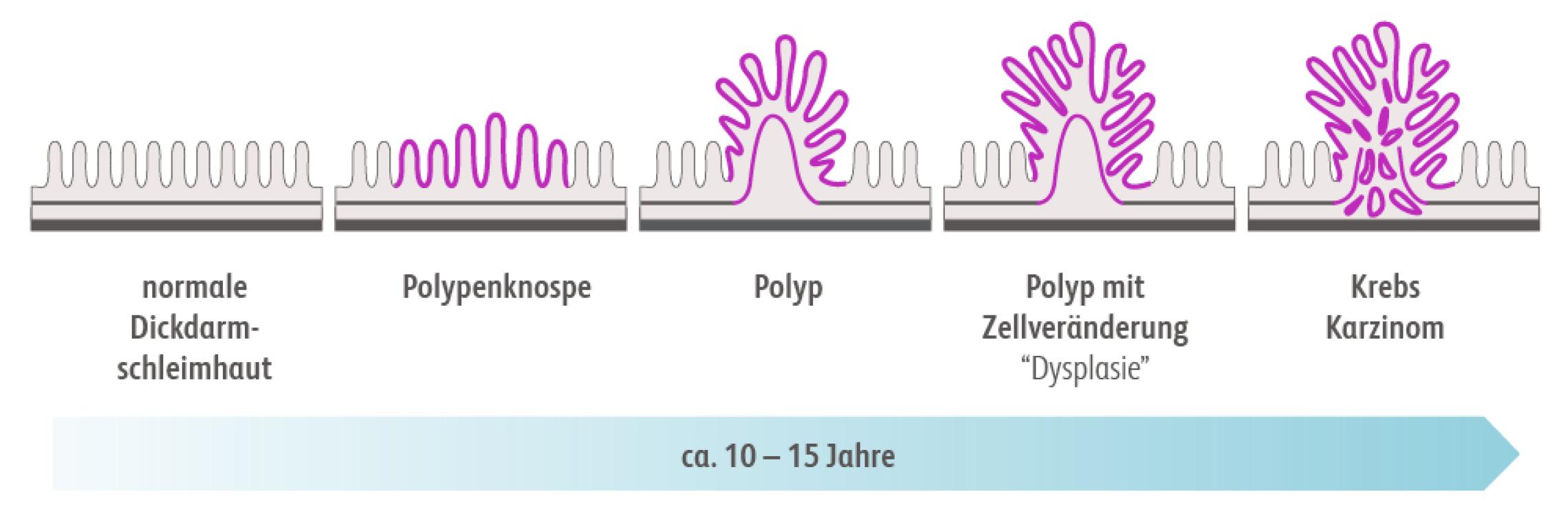 Darmkrebs – kolorektales Karzinom | BMS-Pflege-Onkologie